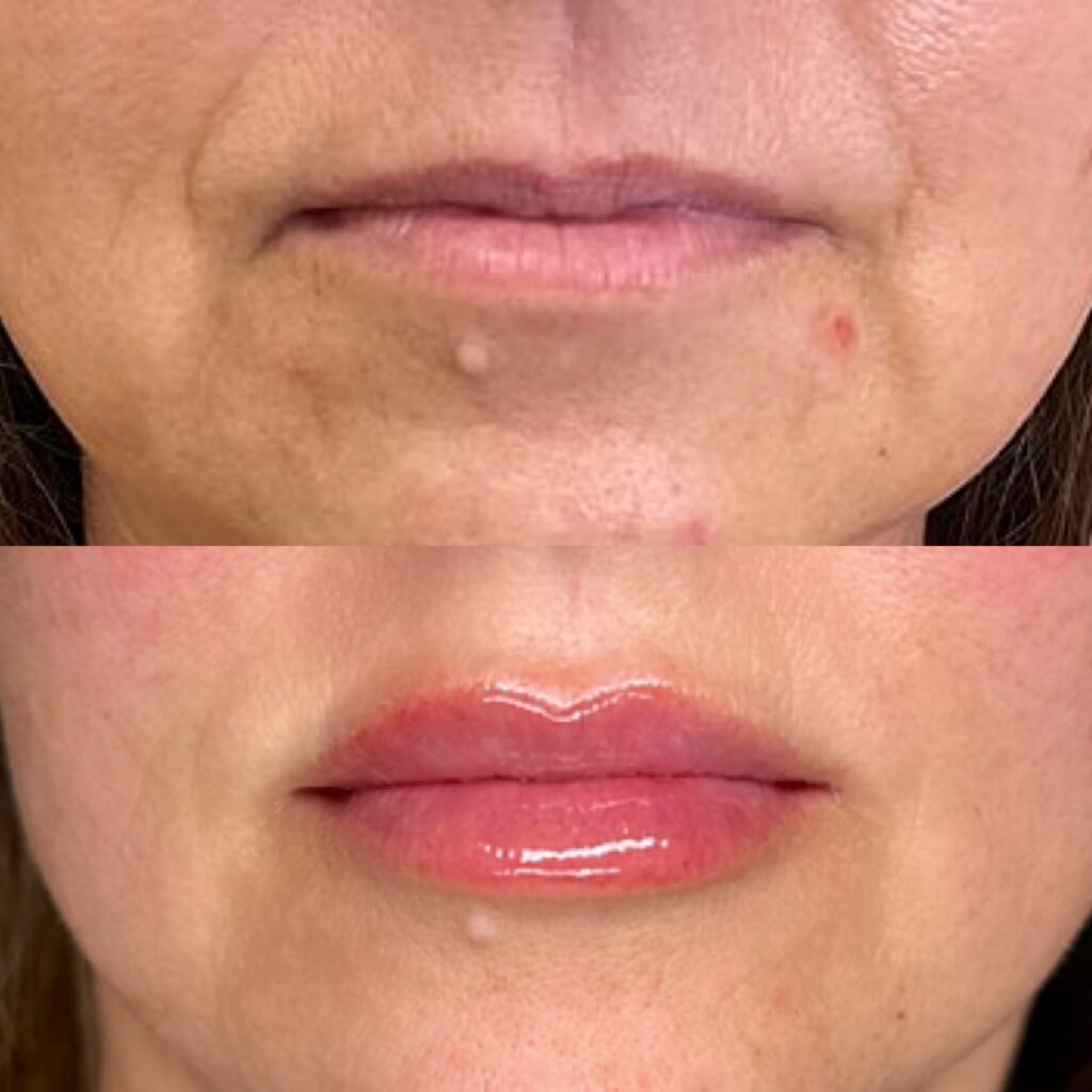 Lip Filler in Lakewood Ranch FL - Natural Results | Serving Bradenton ...