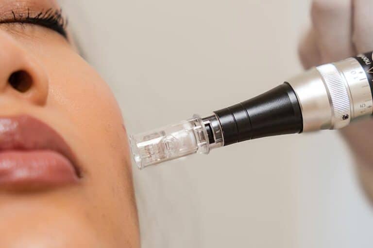 Microneedling with Exosomes | Lakewood Ranch, FL | Venice FL ...